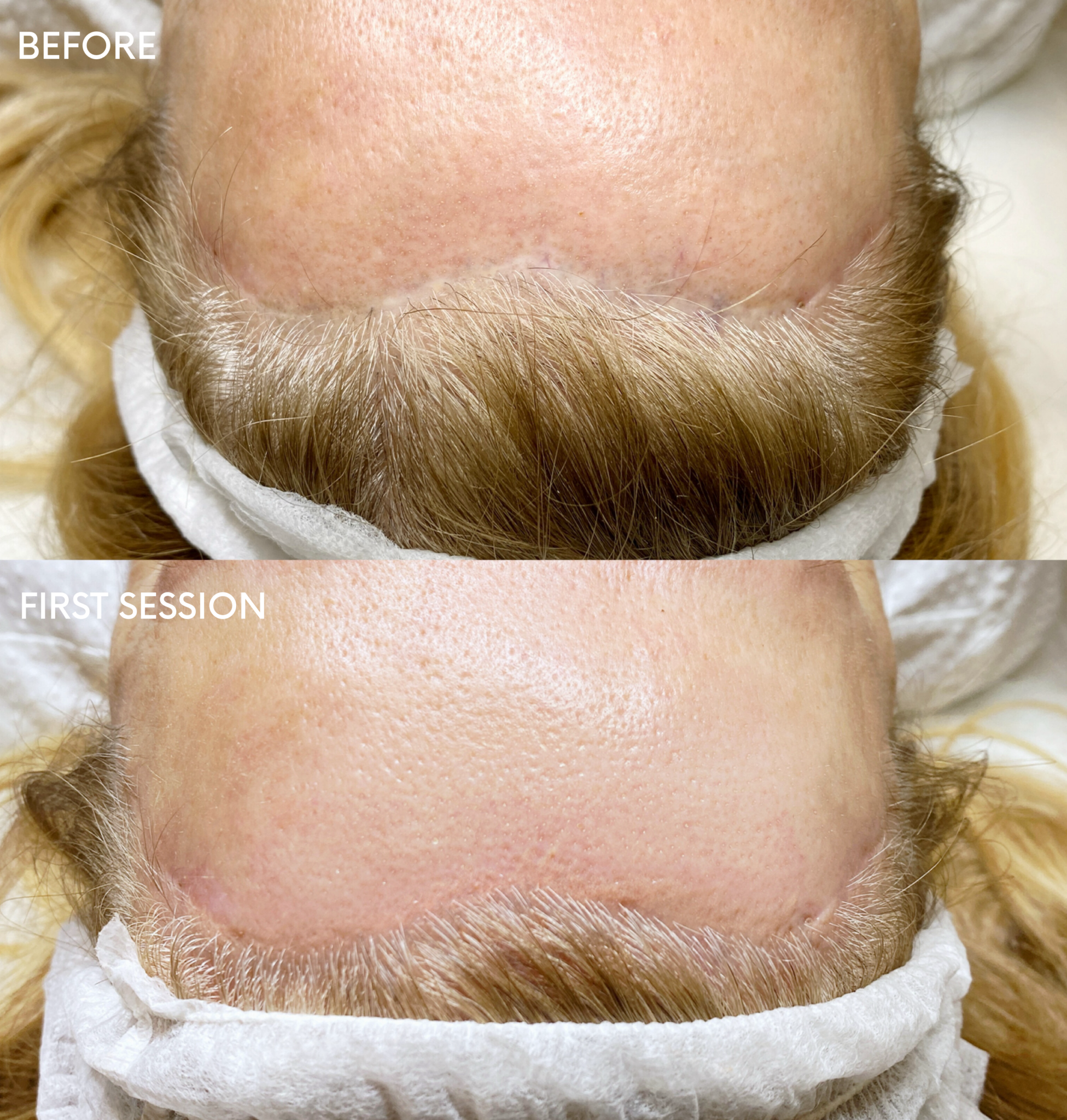 FLEXIBLE DATES | 3-DAY Stretch Marks, Scar Camouflage & Areola Tattoo ...